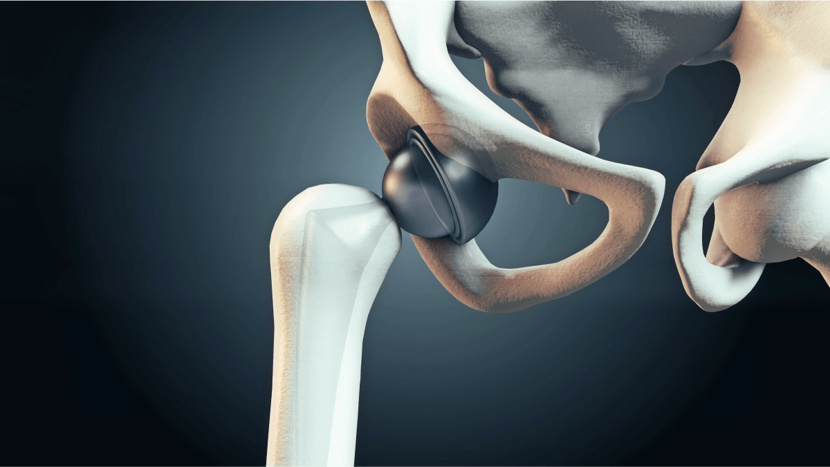 Zimmer Biomet Hip Implant Lawsuit | Recall Update 2024-2025